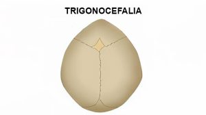 Trigonocefalia - neurocirugia-infantil.com